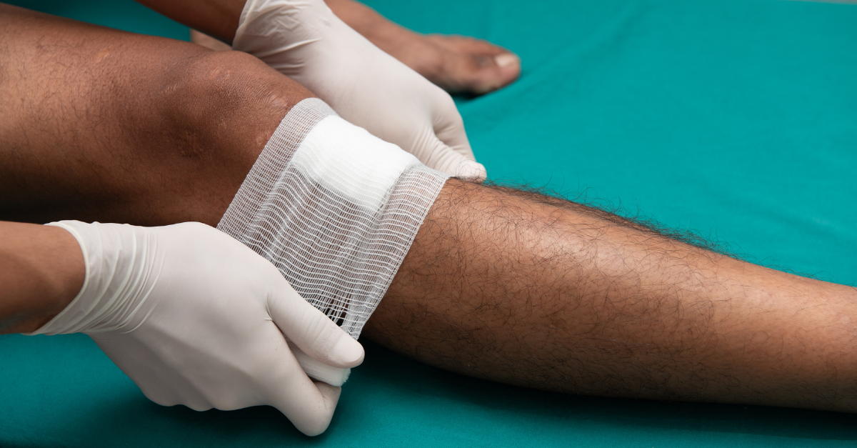 Lábszárfekély: Tünetek, okok és kezelési lehetőségek - Human Medical